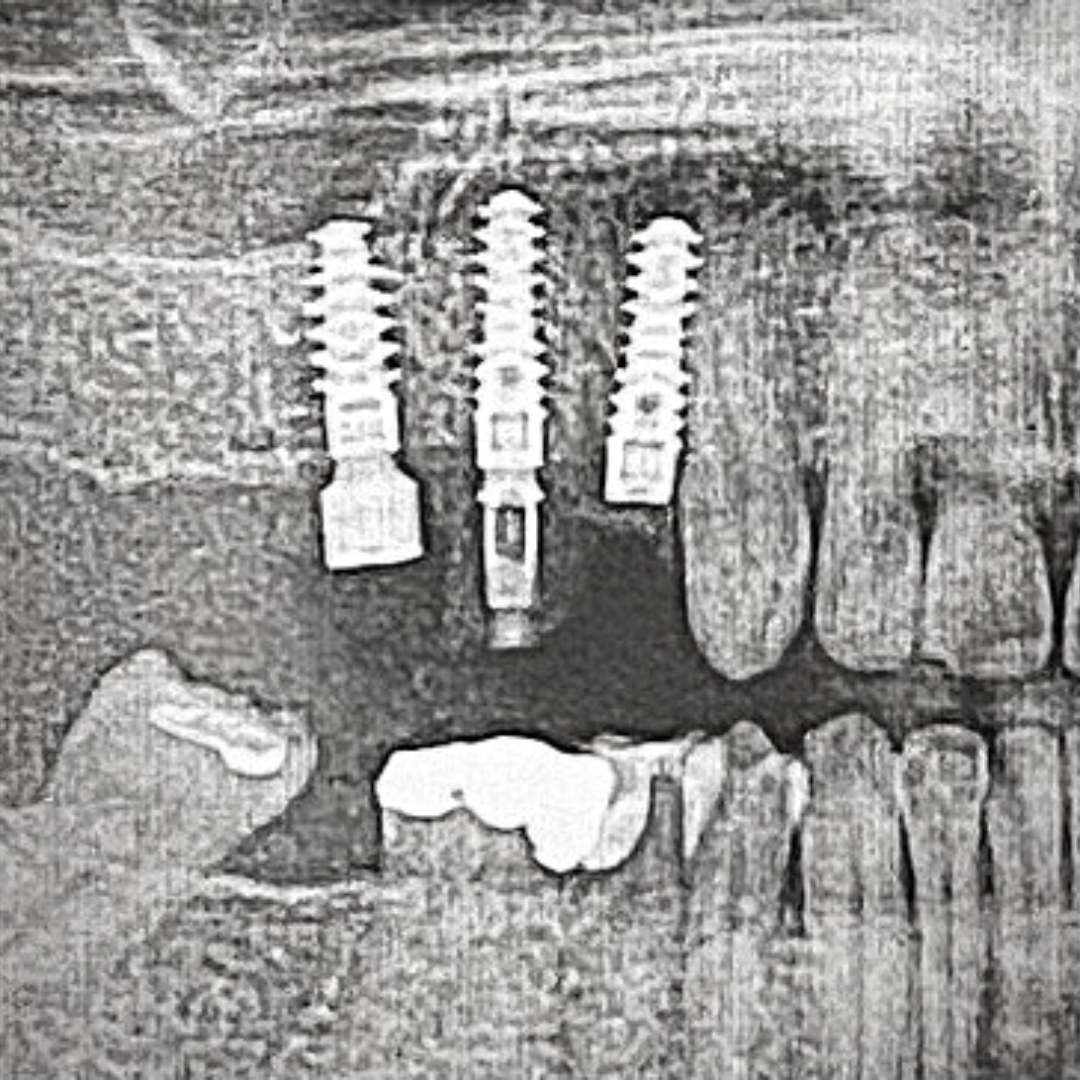 Full Arch Dental Implant