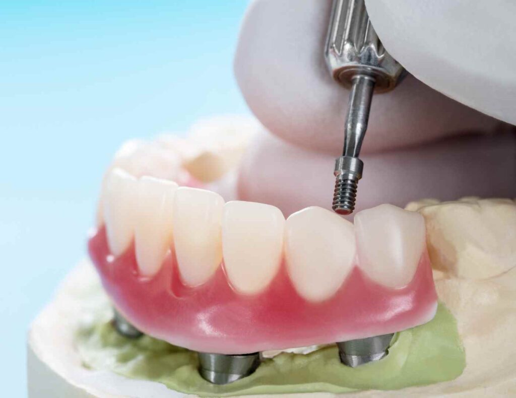 Understanding Implant Overdentures: Benefits, Procedure, and...